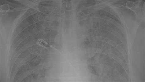 Chest X Ray For Myocardial Infarction At Elaine Baltimore Blog