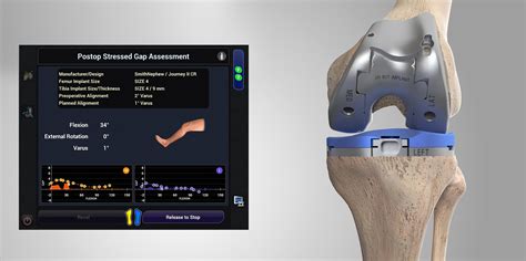 Robotic Knee Replacement Clinic Navkaar Hospital