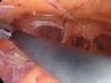 Endoscopic Inguinal Sentinel Lymph Node Biopsy In Vulvar Squamous Cell Carcinoma Video