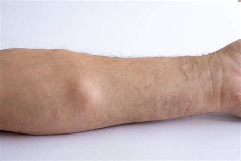 50 Facts About Liposarcoma