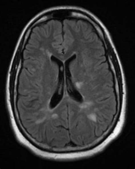 Explain Multiple Sclerosis Brain Mri