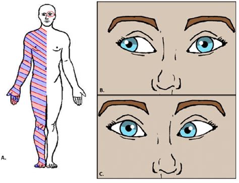 Clinical Manifestations Of Medial Pontine Syndrome A Body