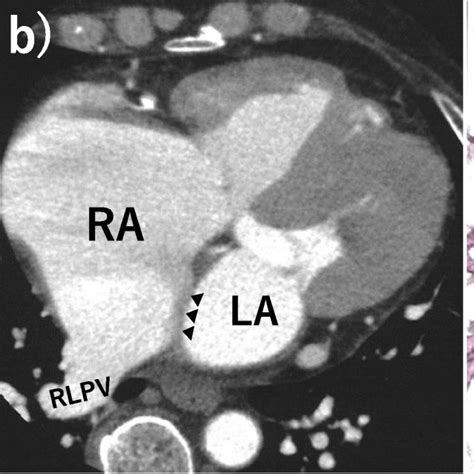 Preoperative Multidetector Computed Tomography Angiography Download Scientific Diagram