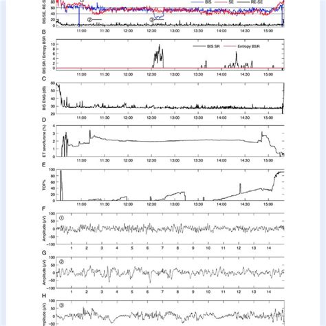 The Effect Of Emg Activation On Bis Bispectral Index® And Se State