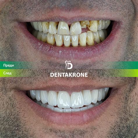 Галерия от случаи Дентална клиника Dentakrone Кърджали Стоматологични услуги