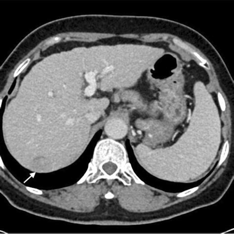 The Extent Of Hepatectomy Was Determined By Icg Fluorescence Navigation Download Scientific