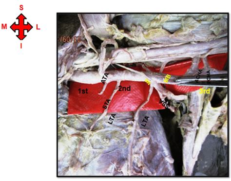 Illustration Showing Subscapular Artery And Thoracodorsal Artery