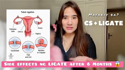 Masakit Ba Ang Ligation Cs Ligate Bilateral Tubal Ligation After