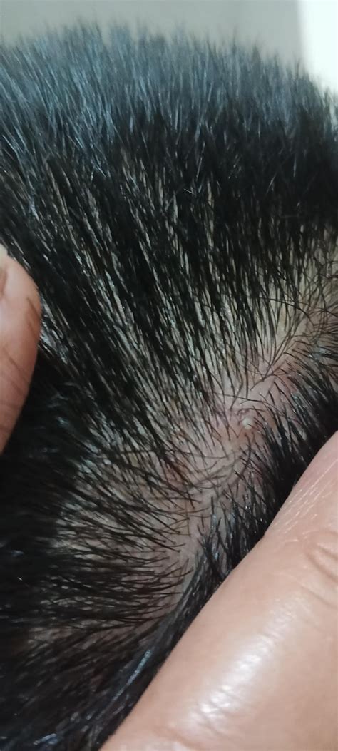 Do I Have Scalp Folliculitis I Have Bumps Pimples And Redmarks Its Been 1 Year Since I Have