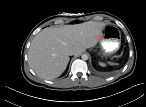 Axial Abdominal Computed Tomography 1 Week After The Removal Of The Download Scientific Diagram
