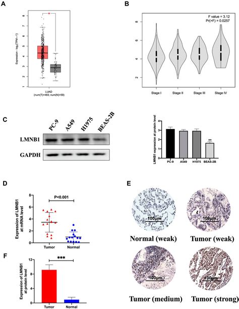 Lmnb1 Was Upregulated In Luad Tissues Compared With Paracancerous