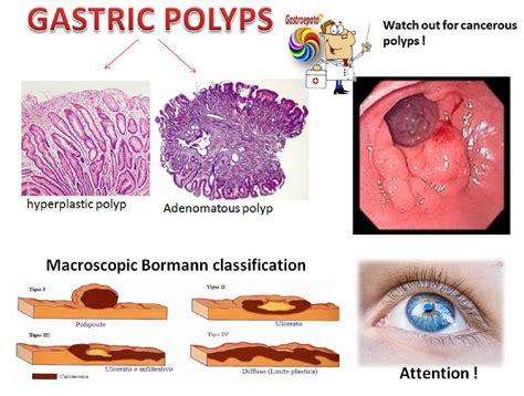 Hyperplastic Polyp Vs Adenomatous Polyp