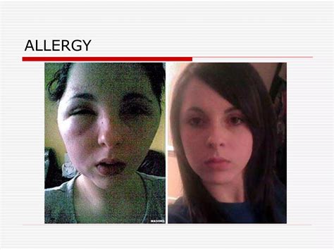 Systemic Complications Ppt