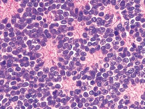 Ewing Sarcoma Hip Histology