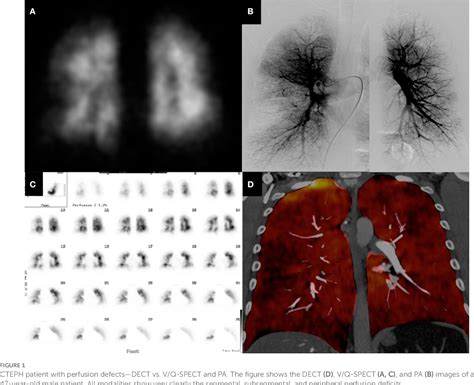 Figure 1 From Evaluation Of Diagnostic Accuracy Of Dual Energy Computed