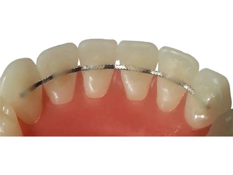 Orthodontic Wires And Springs Dental And Orthodontic Supplies Uae Heather And White