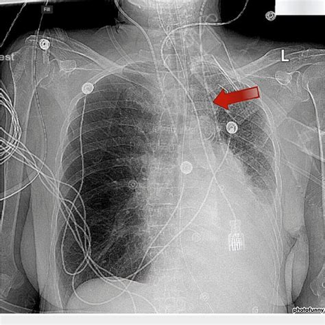 Figure 1 From A Rare Presentation Of Duplicate Superior Vena Cava