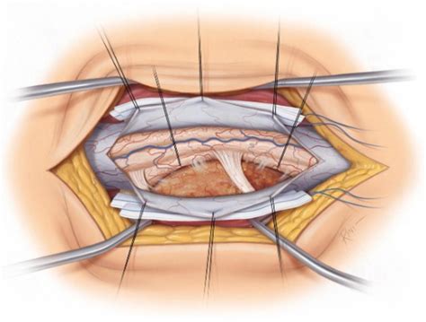 Most Intradural Extramedullary The Neurosurgical Atlas