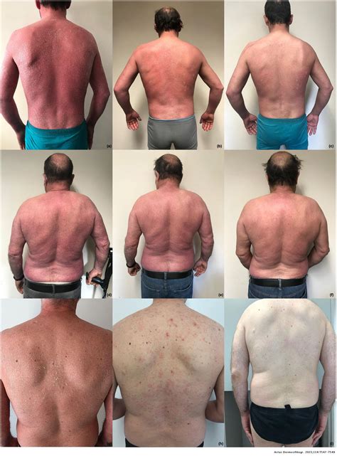 Artículo Traducido Psoriasis Eritrodérmica Exitosamente Tratada Con