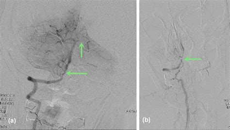 Dsa 8 H After Symptom Onset Showed A Significant Stenosis In The