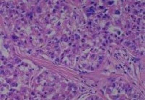 Novus Biologicals Human Liver Tissue Microarray Cancer Metastasis