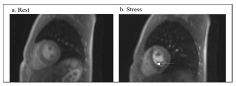 Safety And Efficacy Of Regadenoson For Pediatric Stress Perfusion
