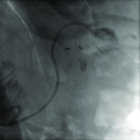 Fluoroscopy Stent Placement Of The Pancreatic Duct With 85f