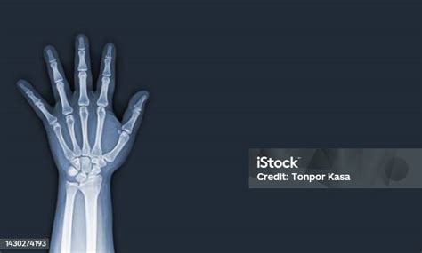 손과 손목 관절의 Xray 이미지는 Ap가 의료 진단을 위해 부상 힘줄 연조직 부종을 볼 수 있도록 봅니다 의료 이미지 개념 및 복사 공간 0명에 대한 스톡 사진 및 기타