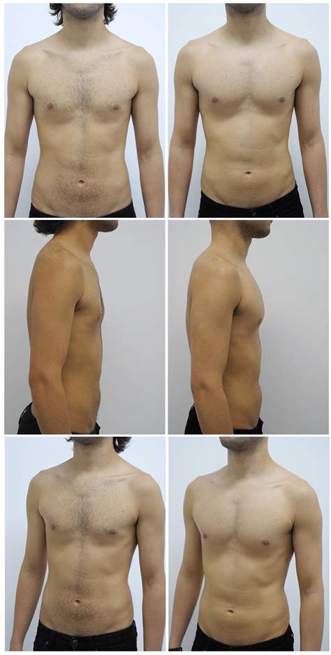 Male Pectoral Implants Dr G Cosmetic Surgery