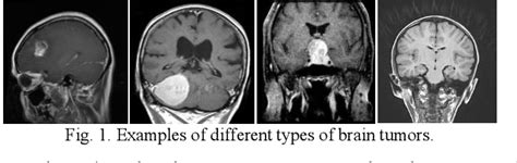 Figure 1 From Deep Learning Model For Classifying Brain Tumors Semantic Scholar