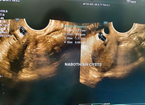 A Nabothian Cyst Is A Common Benign Non Cancerous Cyst On The Cervix… Dr Kamrun Nahar Tulti