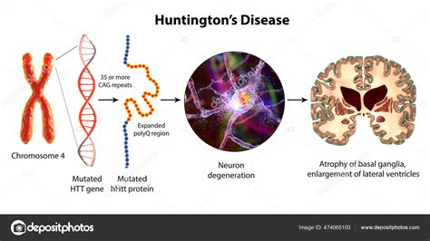 Molecular Genesis Huntingtons Disease Illustration Expansion Cag Trinucleotide Sequence Htt