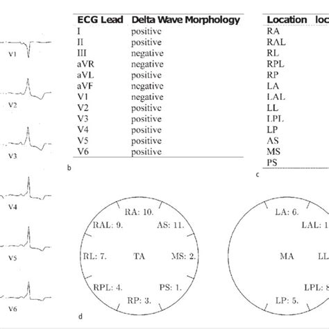 A Representative Example Of A Patient With An Accessory Pathway For Download Scientific Diagram