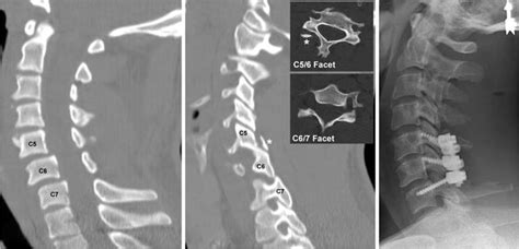 Management Of Cervical Facet Fractures Surgical Indications And Approach Neupsy Key