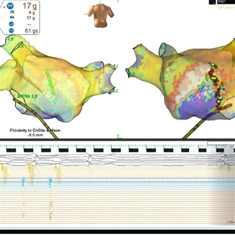 Isochronal Tridimensional Mapping Of Left Atrial Flutter In Upper Panel Download Scientific
