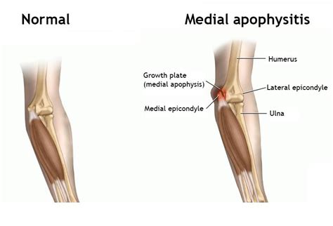 Little Leaguers Elbow Atx Physical Therapy