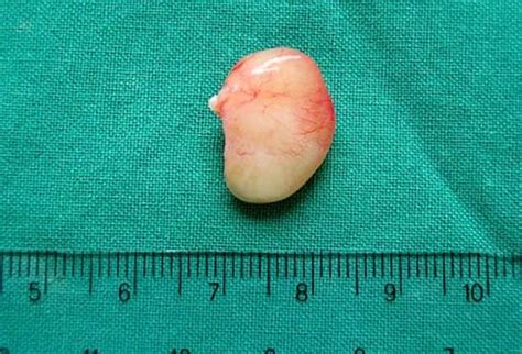 Polyp Pictures What They Are And What Polyps Look Like