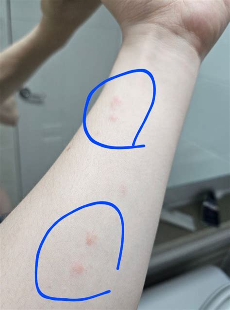 피부 가려움 및 붉은 반점 지식in