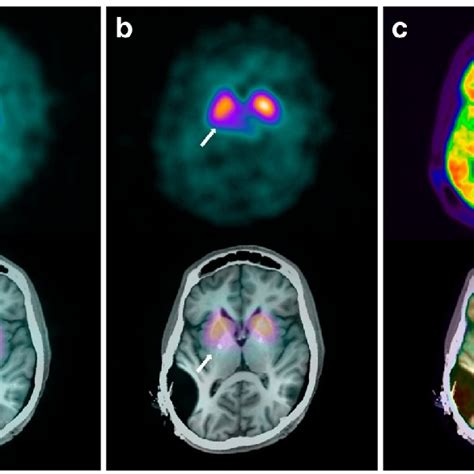 Brain Radiotracer Imaging Of Pre And Postsynaptic Striatal Dopamine