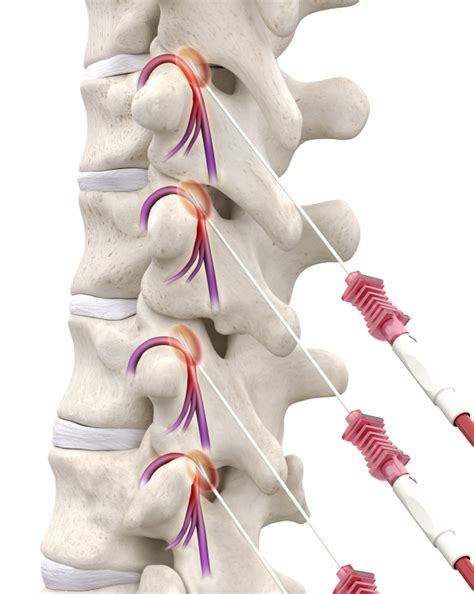Radiofrequency Ablation Interventional Spine