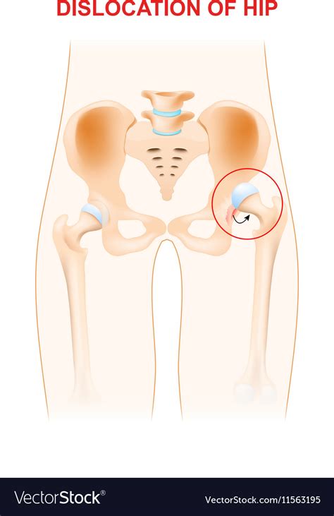 Dislocation Of Hip Royalty Free Vector Image Vectorstock