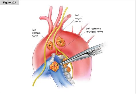 Lymph Node Dissection Springerlink