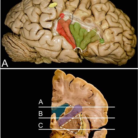 Exposure Of The Insular Cortex And Subcortical Region Was Achieved With Download Scientific