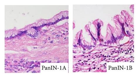 Histology Of Biliary Intraepithelial Neoplasia Bilin And Pancreatic