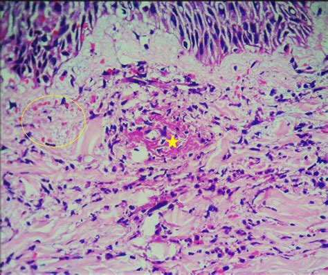 “degeneration” In Dermatopathology Indian Journal Of Dermatology