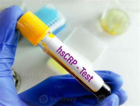 Blood Sample Tube For Hs Crp Or High Sensitive Crp Test For The Blood Sample Tube For Hs Crp Or High Sensitive Crp Test For The