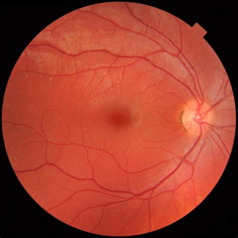 Fundus Photography Wikipedia