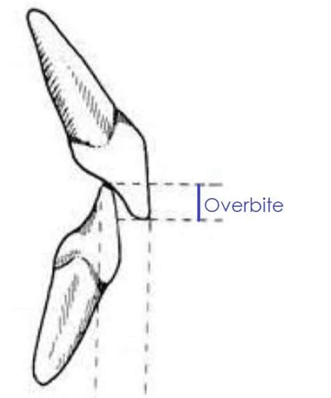 Let S Talk About Overbites High Line Orthodontics