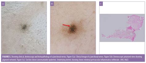 A Clinical Dermoscopic And Histopathological Analysis Of Common Acquired Melanocytic Nevi In