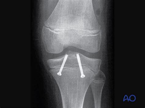 Open Reduction Screw Fixation For Avulsion Of The Tibial Spine